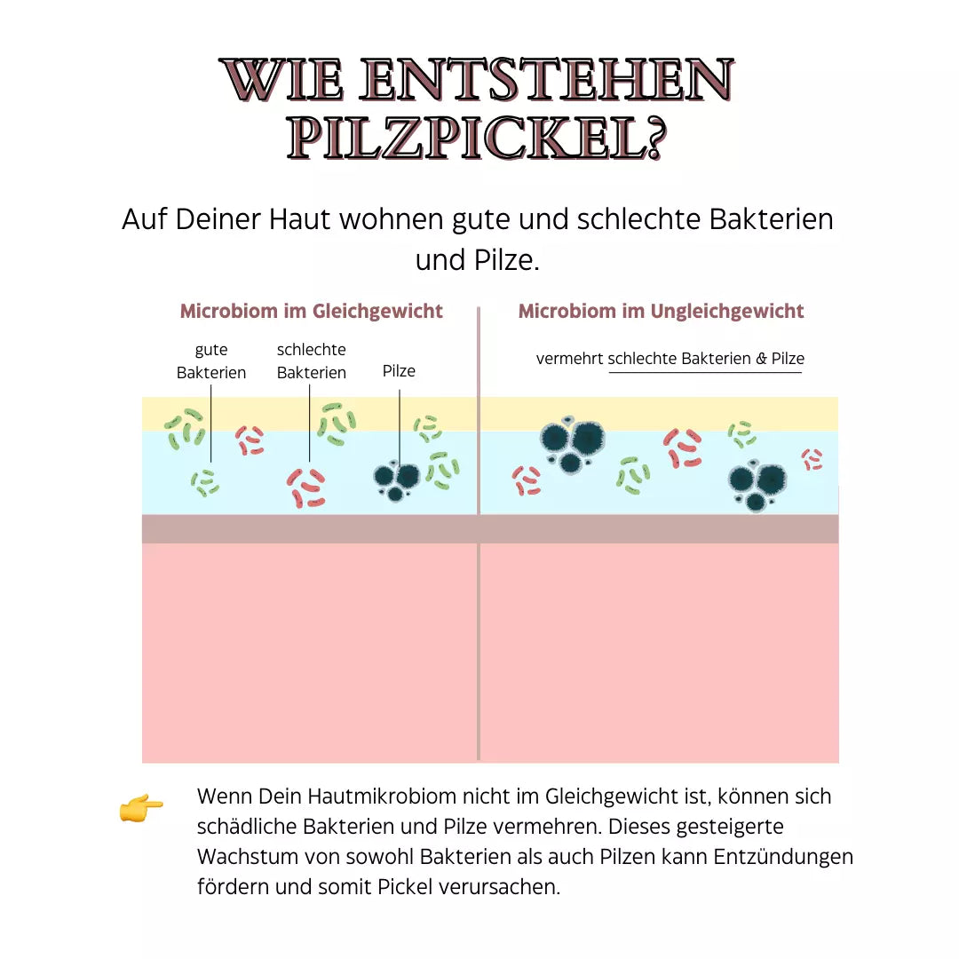 Das 🍄 Mini-Pickel & Unterlagerungen Set von HAUTTIEF.com 🛍️