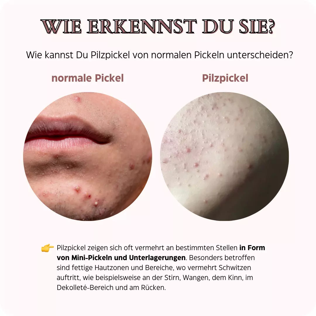 Das 🍄 Mini-Pickel & Unterlagerungen Set von HAUTTIEF.com 🛍️